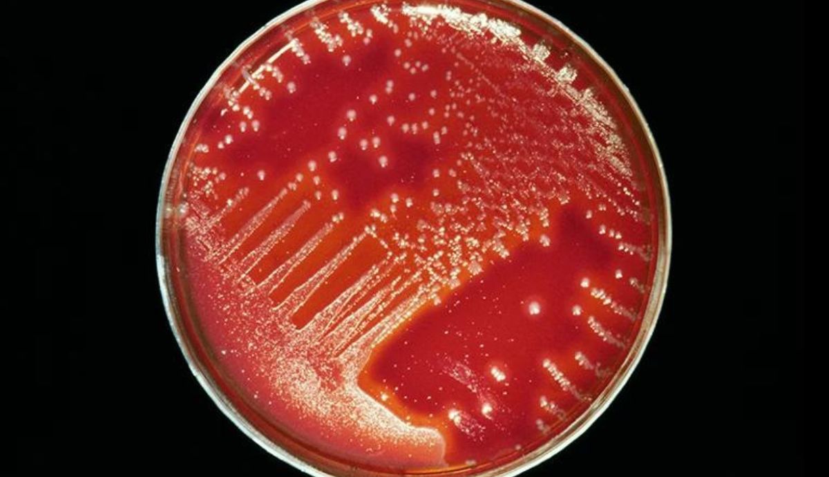 Estreptococo En La Cara